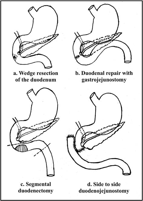 Schematic Diagram Showing Techniques Of Limited Distal Duodenal Resection Download Scientific