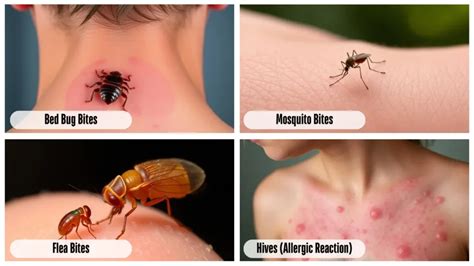 bed bug bites on skin pictures symptoms and treatment