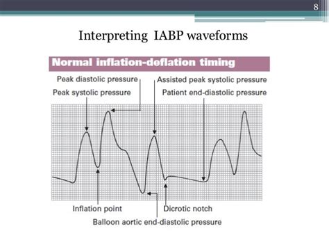 Iabp