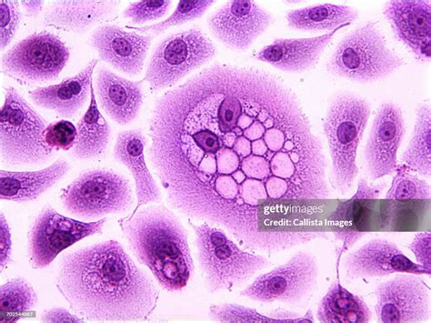 Koilocytes Squamous Epithelial Cells Altered By Human Papillomavirus
