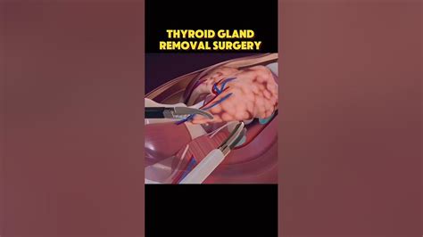Thyroid Gland Removal Surgery Viralvideo Health Science Doctor