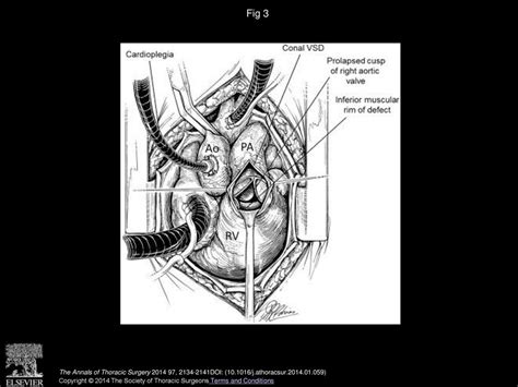Doubly Committed And Juxtaarterial Ventricular Septal Defect Outcomes Of The Aortic And