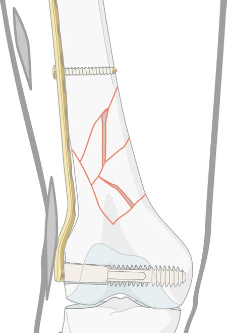 History And Evolution Of Minimally Invasive Plate Osteosynthesis Musculoskeletal Key