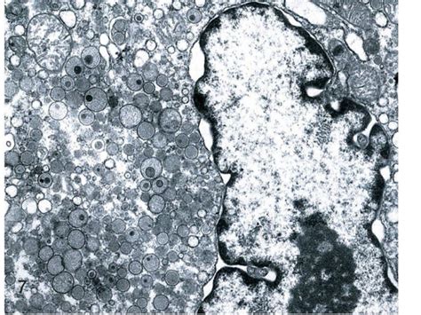Histiocytic Sarcoma Numerous Lysosomes Are Seen In Neoplastic Cell Download Scientific Diagram