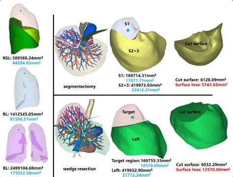 Segmentectomy Or Wedge Resection Of Rs1 Rsl Right Superior Lung Rl Download Scientific
