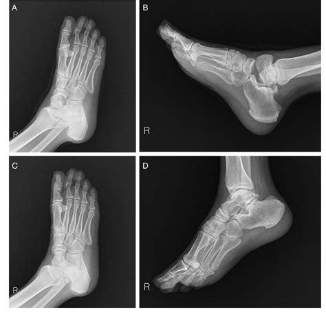 Talus Lateral Process Fracture