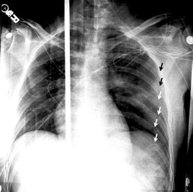 X Ray Broken Ribs Broken Ribs Rugby And Acupuncture