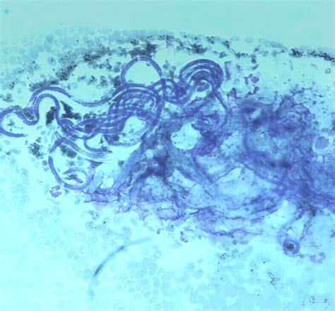 Jerad Gardner Md ‪how I Handle Nonspecific Ulcers On Biopsy To Rule
