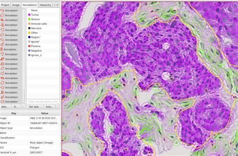 Annotate Tumour Areas In H And E Images Using Qupath Image Analysis