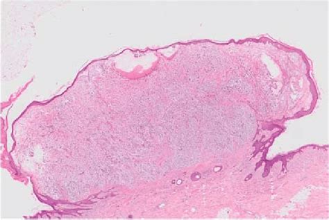 Case 13 Was An Exophytic Lesion With An Epidermal Collarette