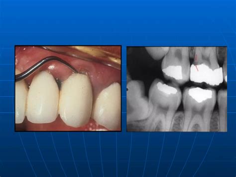 Classification Of Dental Caries PPT Classification Of Dental Caries PPT