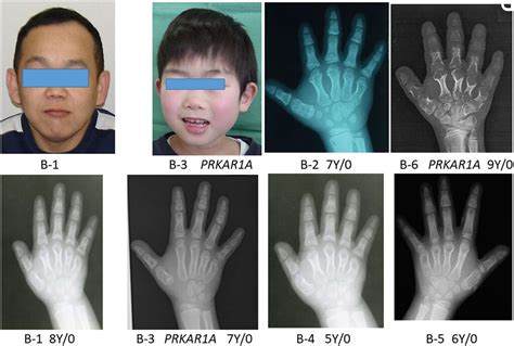 Pseudohypoparathyroidism Face