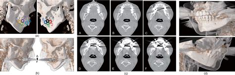 Figure 4 From Three Dimensional Generative Adversarial Nets For Unsupervised Metal Artifact