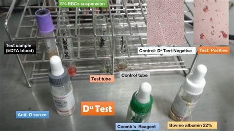 Du Test Introduction Principle Procedure Result Interpretation And Clin