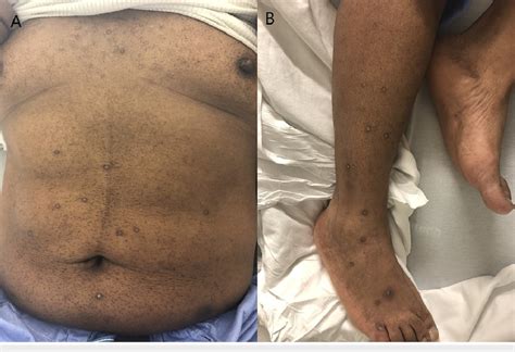 Patient With Hyperkeratotic Papular Rash On The Torso A And Legs B Download Scientific Diagram