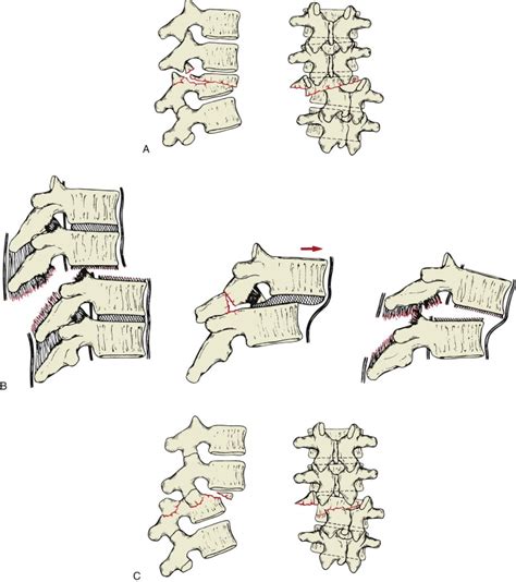 Thoracolumbar Fractures Musculoskeletal Key