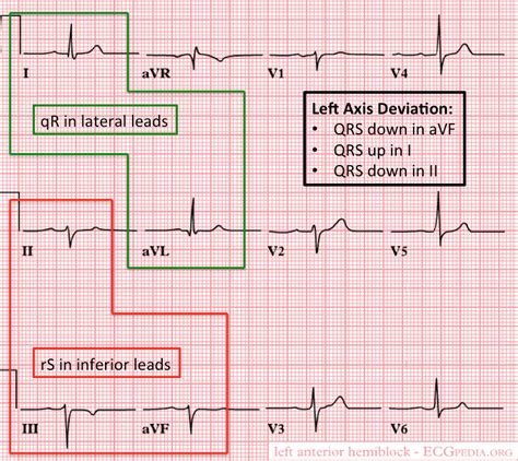 Bundle Branch Blocks 101 Rebel Em Emergency Medicine Blog