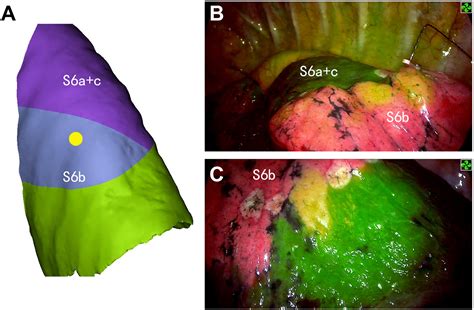 Thoracoscopic Anatomic Left Lower Lobe S6b Subsegmentectomy The Annals Of Thoracic Surgery