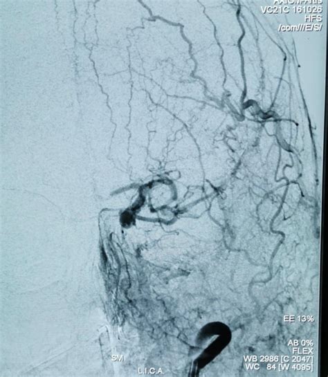 Nikolaos Ptohis Mdmscphdebir On Linkedin Stroke Thrombectomy