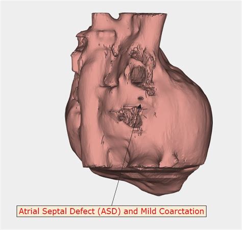Stl File Congenital Heart Disease Classification Chd ・3d Printable Model To Download・cults