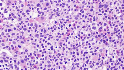 Developing A Pathomics Imaging Technique To Assess Bone Marrow In Mpns