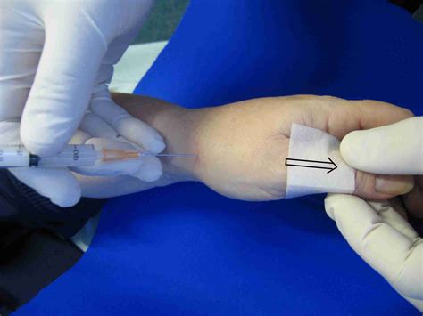 Thumb Cmc Joint Injections