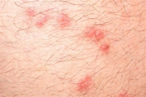 How To Identify These 9 Common Bug Bites Readers Digest