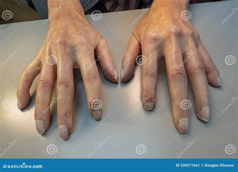 Female Patient Hands With Scleroderma Stock Image Image Of Illness