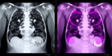 Revolutionizing Breast Cancer Detection Ai Boosts Results In Germanys Mammography Screening