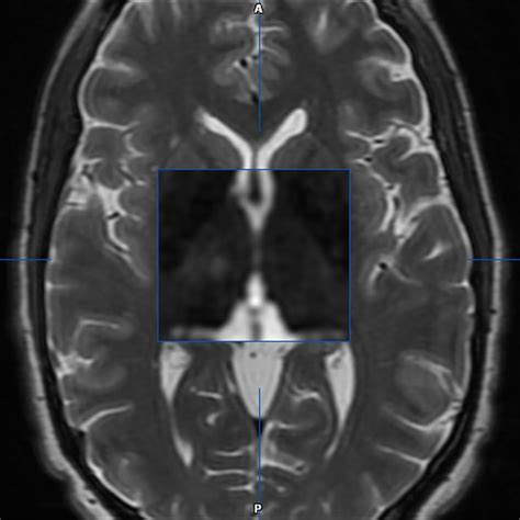 Transcranial Magnetic Resonance Imaging Mriguided Focused