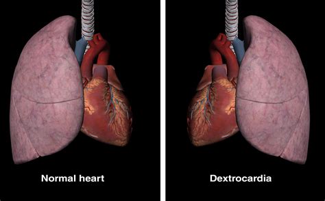 Dextrocardia