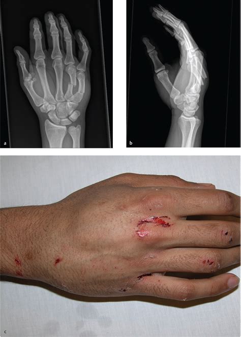 Case 60 Metacarpal And Phalangeal Fractures Plastic Surgery Key