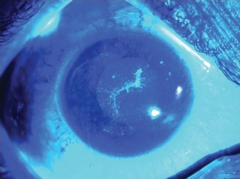 Case 1 Fluorescein Staining Of Corneal Pseudodendrite Open I