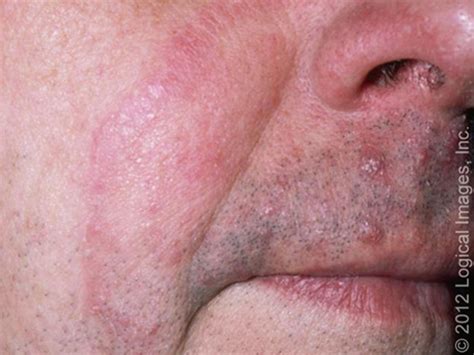 Tinea Faciei African American