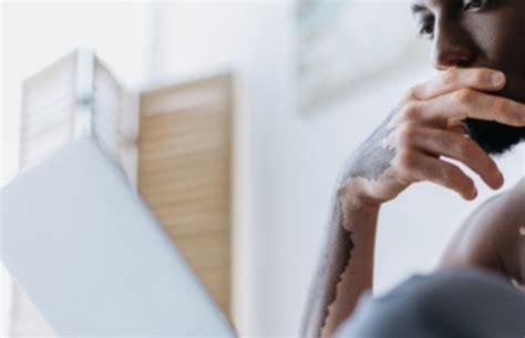 Ritlecitinib Clinical Trial Now Recruiting The Vitiligo Society