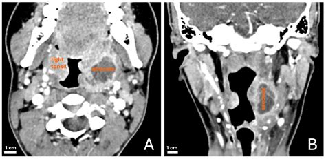 Diagnosis Of Peritonsillar Abscess—a Prospective Study Comparing