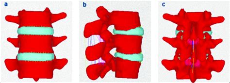 The Intact Finite Element Model Of Lumbar Spine L3 L5 Used In This Download Scientific