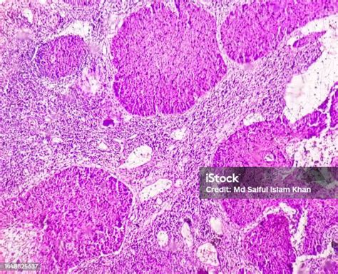 혀 편평 세포 암종 등급 Ii를 보여주는 현미경 사진 구강 침습성 Scc 질병에 대한 스톡 사진 및 기타 이미지 질병 현미경 슬라이드 0명 Istock