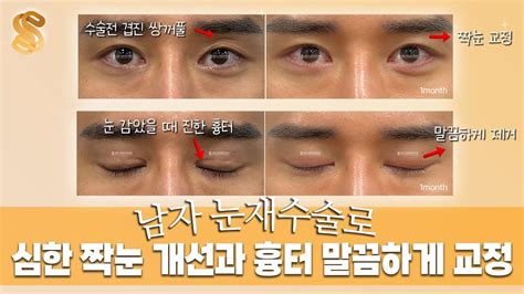 남자 눈재수술로 심한 짝눈 쌍꺼풀 흉터 말끔하게 교정 Youtube