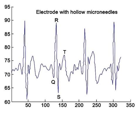 Ecg Signal Measurement From The Biopotential Electrode With Hollow