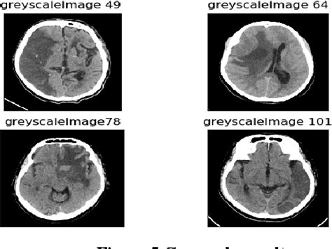 Figure 1 From Machine Learning Algorithm For Stroke Disease