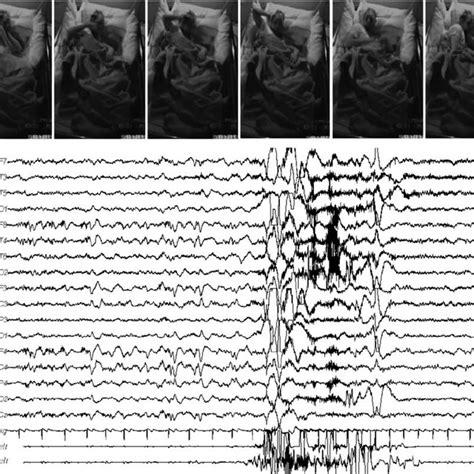 Video Images Upper Part And Scalp Eeg Recording Lower Part Of An Download Scientific