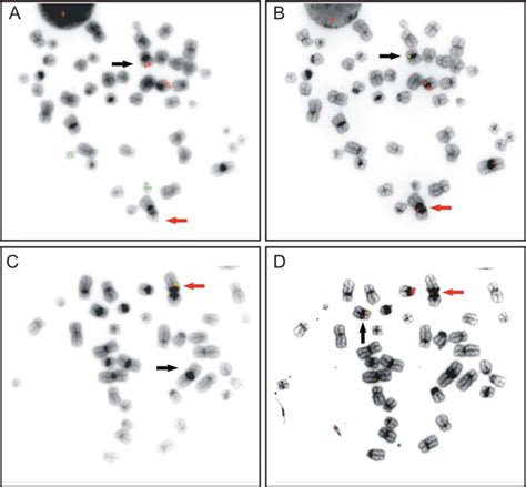 Fish Analysis Of Case 7 A Metaphase Hybridized With Probes Specific