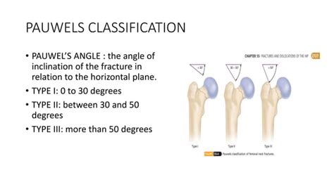 Intracapsular Fracture Neck Of Femur Pptx Death Injury Or