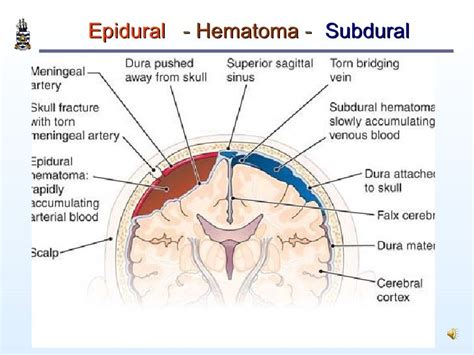 Anatomy Epidural Vs Subdural Hematoma Image