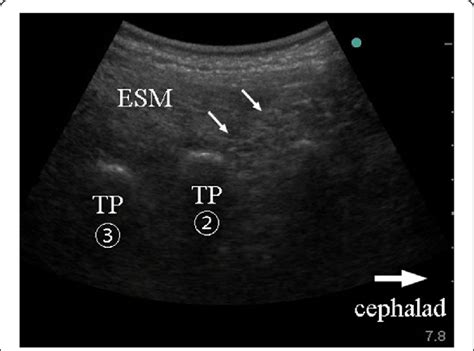 Ultrasound Image For Guidance During Erector Spinae Plane Esp Block Download Scientific