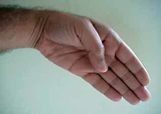 Instruct The Patient To Flex The Thumb Across The Palm And Then Ulnar