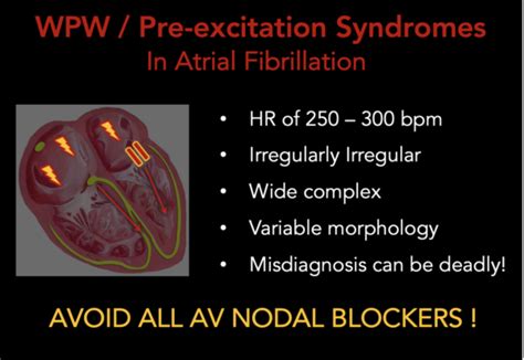 Afib With Wpw Ecg Weekly