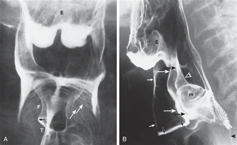 Laryngeal Vestibule Penetration
