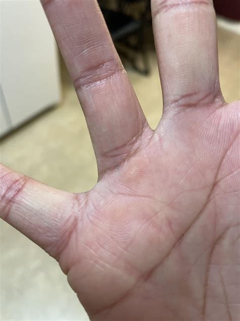 How Did You Symptoms Start Hands Prior To Diagnosis R Scleroderma